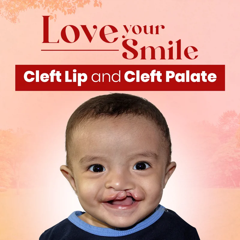 Cleft Lip And Palate Types